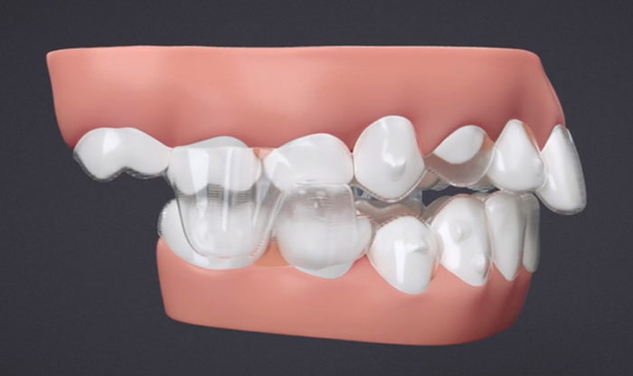 Tratamento Ortodôntico Invisalign com Avanço Mandibular